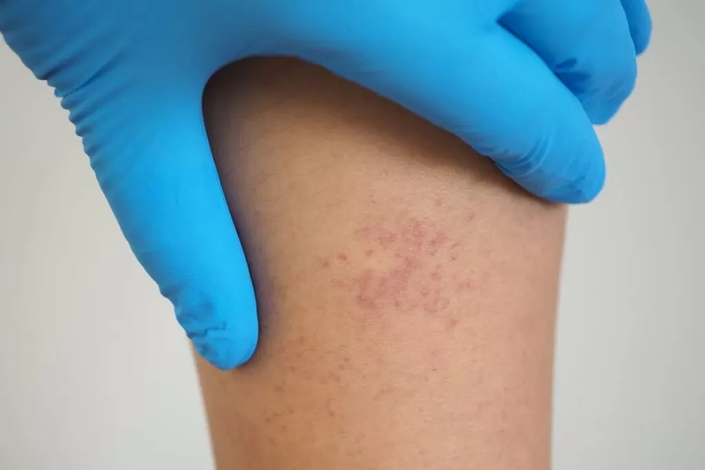 ABC sobre la púrpura trombocitopénica trombótica