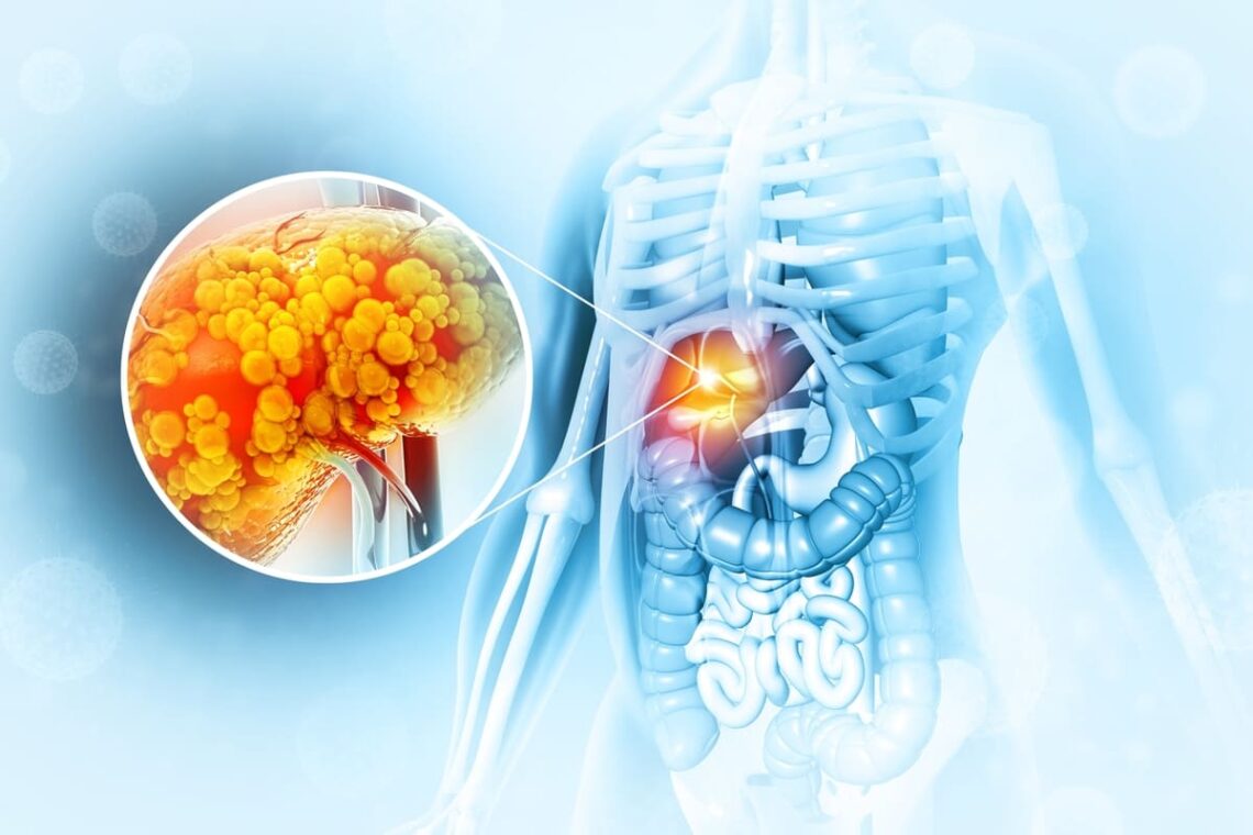 La FDA aprueba Rezdiffra como tratamiento para cicatrices hepáticas ...